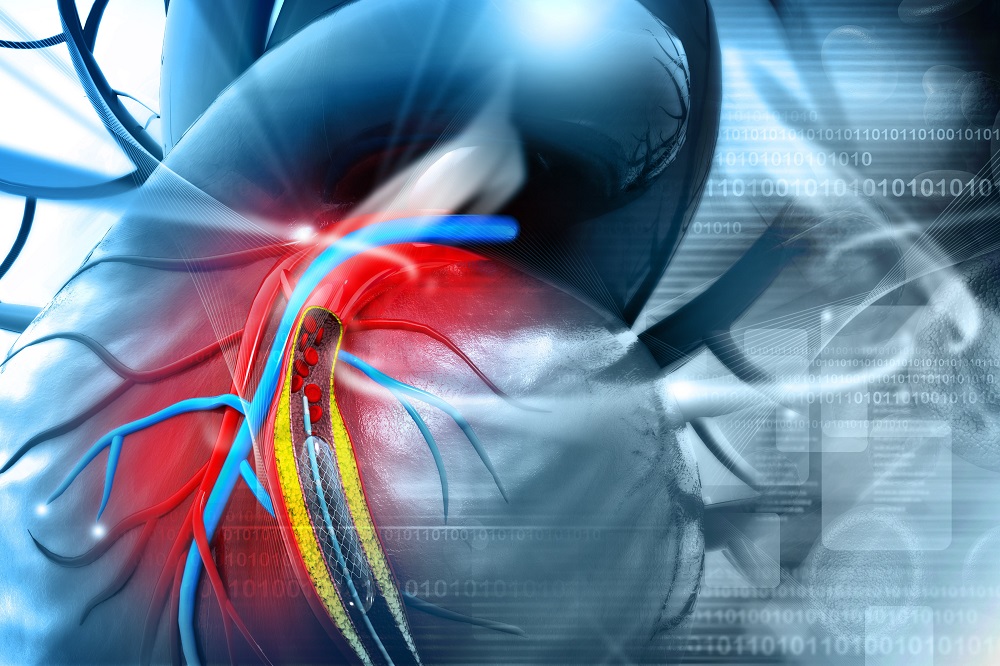Stent beültetése - KardioKözpont